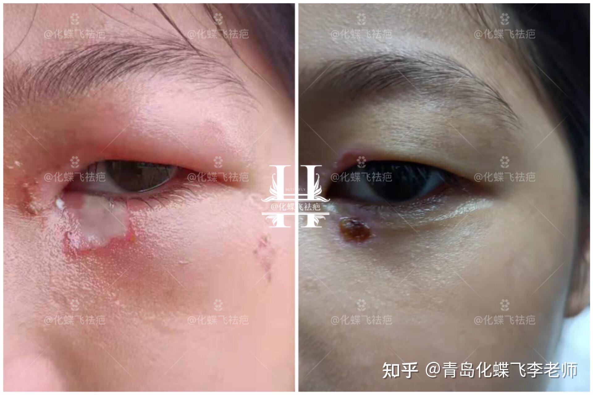 烫伤立刻用中药修复 - 知乎
