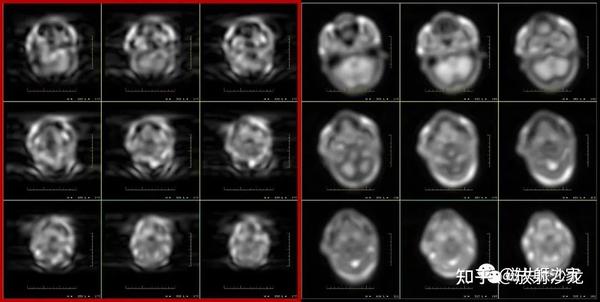 MRI扫描，一定要重视这4个细节！ - 知乎