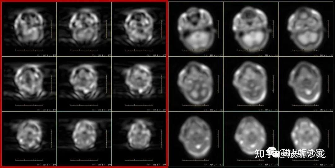 MRI扫描，一定要重视这4个细节！ - 知乎