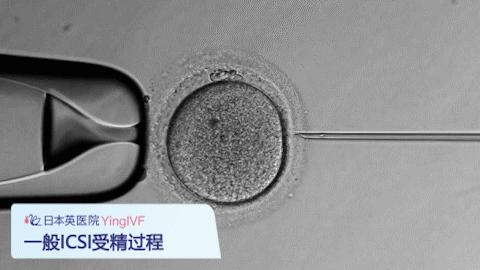 日本二代试管新科技 ，Piezo-ICSI强势助攻精卵结合 | 英科技 - 知乎