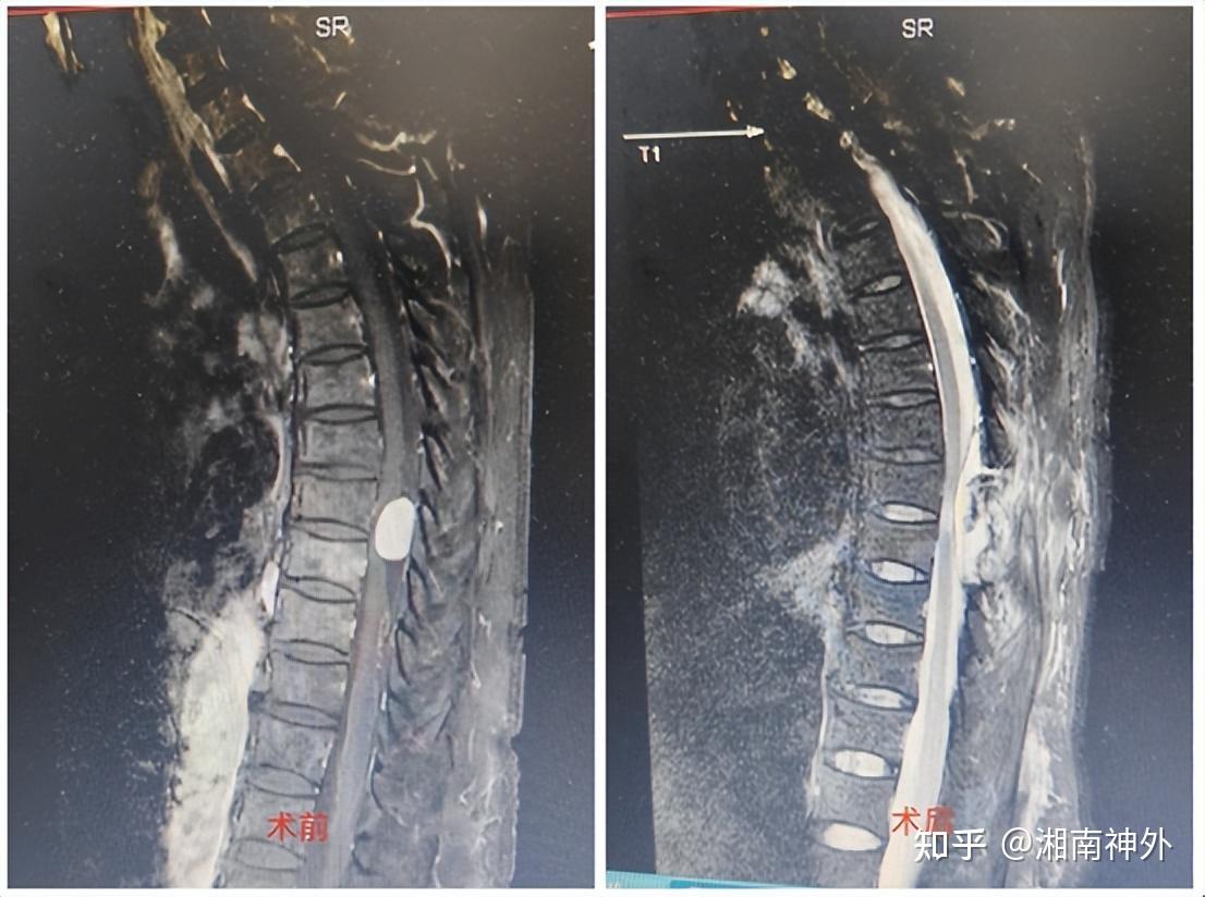『卓越医疗』让脊膜瘤不再留 - 知乎