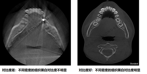 伯爵CBCT影像篇 ⑤：CBCT影像认知 - 知乎