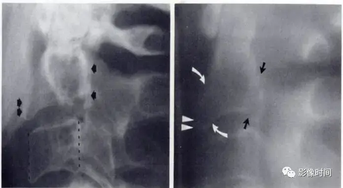 三十种脊柱影像征象，你见过几种？ - 知乎