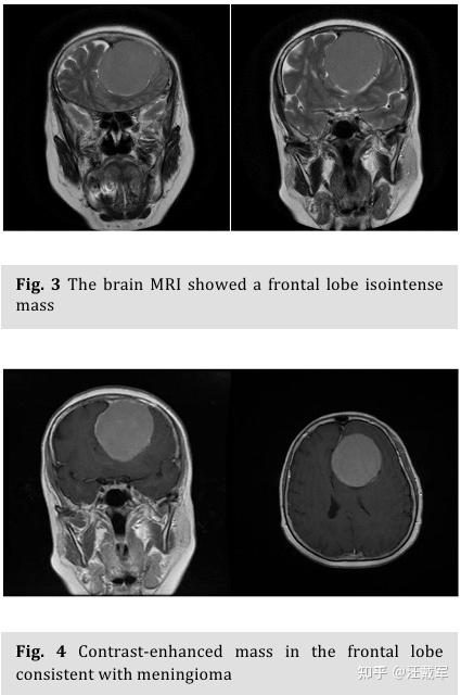 额叶镰旁脑膜瘤引起Foster Kennedy综合征一例 - 知乎