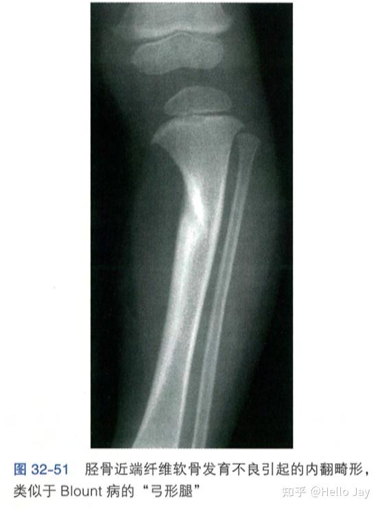 胫骨内翻（Blount病） - 知乎