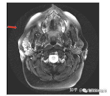 MRI星芒状伪影 - 知乎