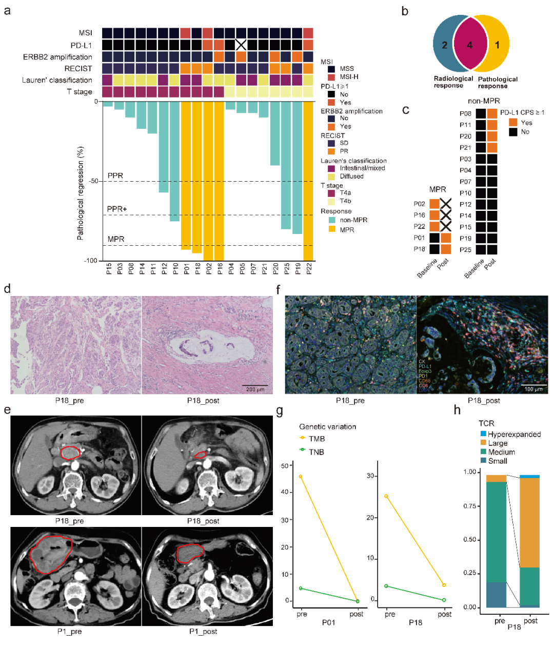 Nat Commun︱山东大学齐鲁医院刘联团队发表免疫联合治疗在胃癌新辅助/转化治疗中的临床研究结果 - 知乎