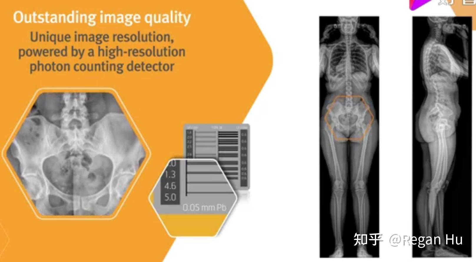 EOS IMAGING EOS全身骨骼三维建模成像系统 - 知乎