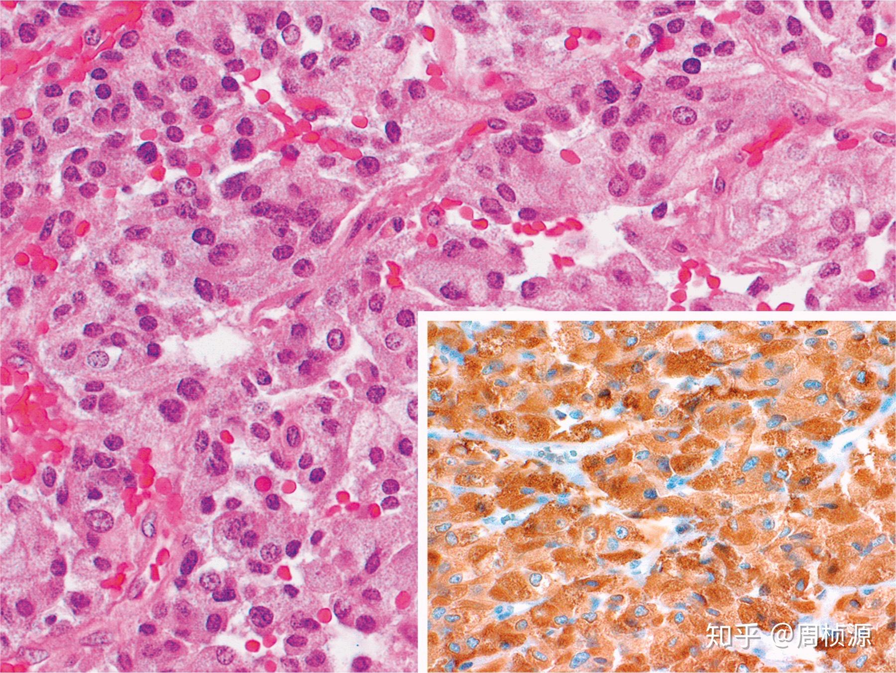 nejm 2018 case 8 - 知乎