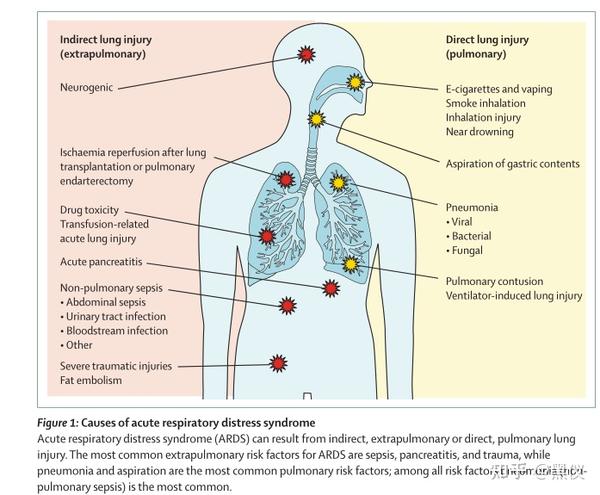 ARDS的病因、病理生理学特征与表型文献综述 - 知乎
