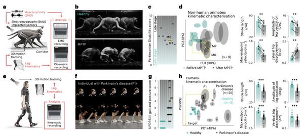 Nat子刊: 多国团队协作在PD患者运动障碍治疗领域取得重要进展！ - 知乎
