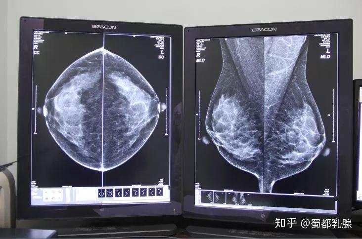乳腺有结节,自己揉揉能行吗? 知乎