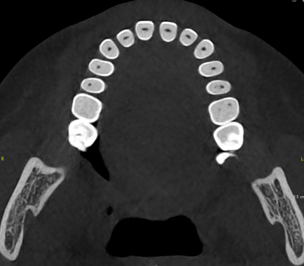 CBCT上空的乌云（1）—— 数据完备性与射线硬化 - 知乎