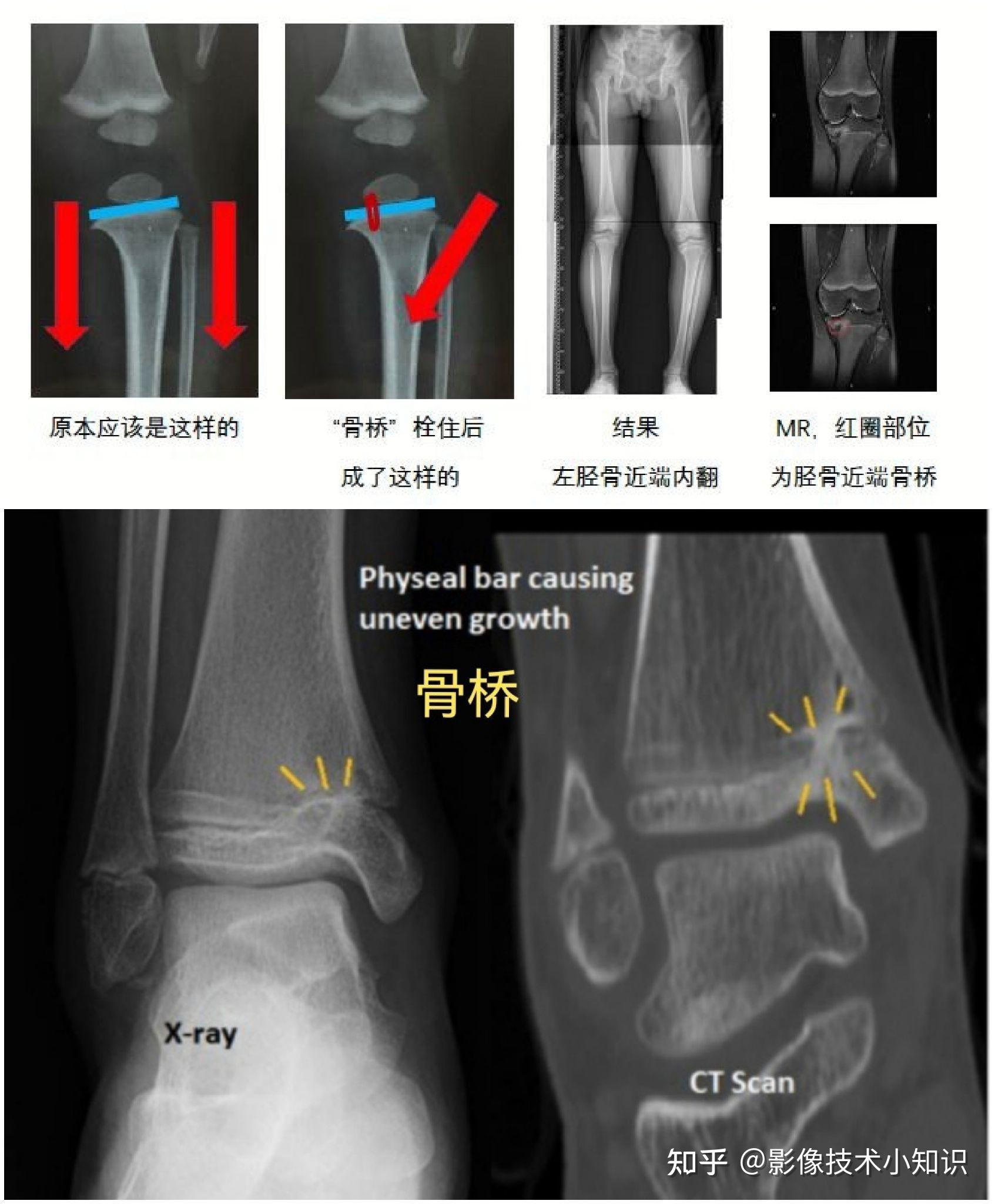骨折影像诊断（2） - 知乎