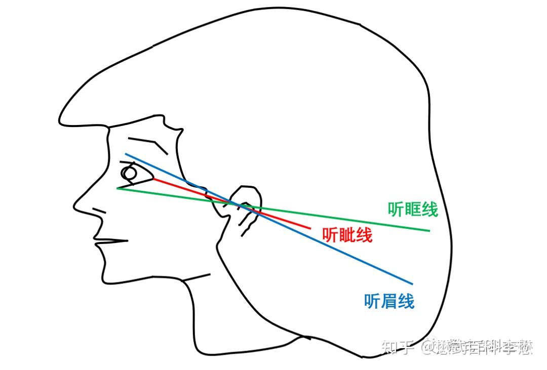 头颅影像学横断面扫描不同角度定位参考线解析 - 知乎