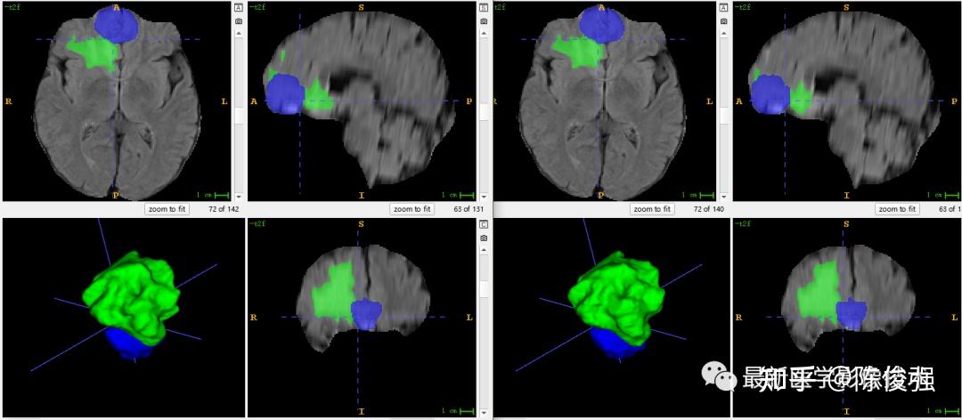 BraTS2023-MEN——BraTS2023颅内脑膜瘤分割挑战赛 - 知乎
