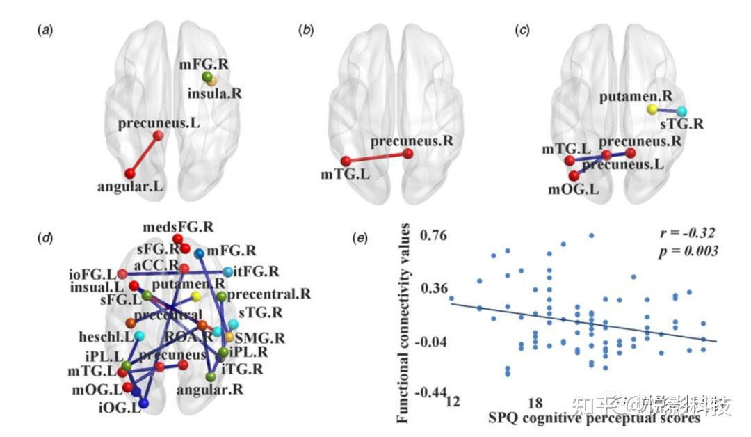 精神分裂型患者大脑结构和功能连接的改变 - 知乎