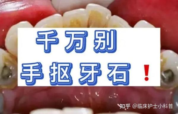 怎么清理牙结石？ 知乎