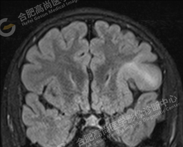 病例科普：头颅MR诊断局灶性皮层发育不良（FCD） - 知乎