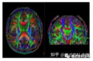 DTI技术原理及临床应用 - 知乎