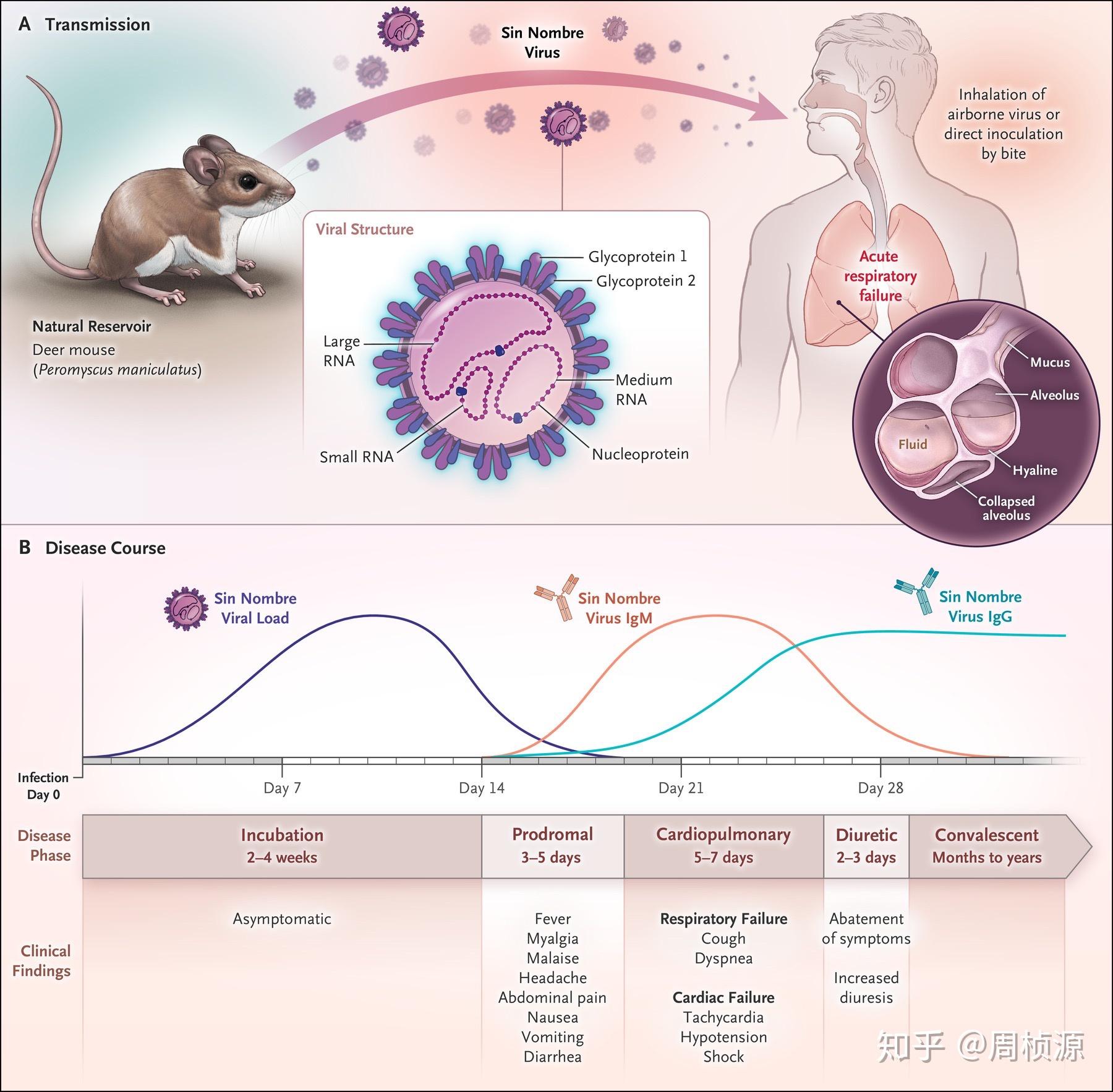 nejm 2020 case 12 - 知乎