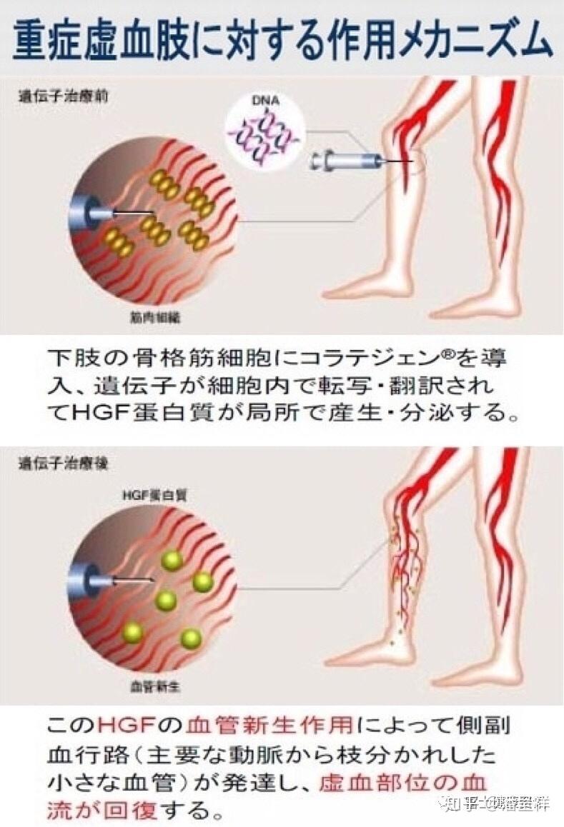 日本医疗保险批准基因治疗新药Collategene，一次注射四万人民币 - 知乎