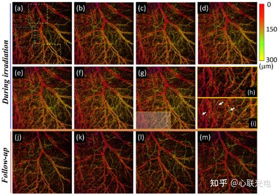Biomed. Opt. Express：利用OCTA检测紫外线诱发的急性皮肤反应 - 知乎