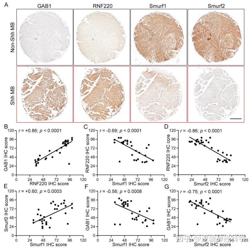 Cell Death Dis︱中科院昆明动物研究所毛炳宇团队发现调控Shh型髓母细胞瘤发生发展的新调控机制 - 知乎