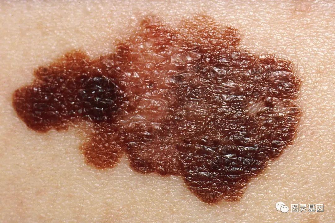 Sci Adv | 黑色素瘤固有NR2F6活性调节抗肿瘤免疫 - 知乎