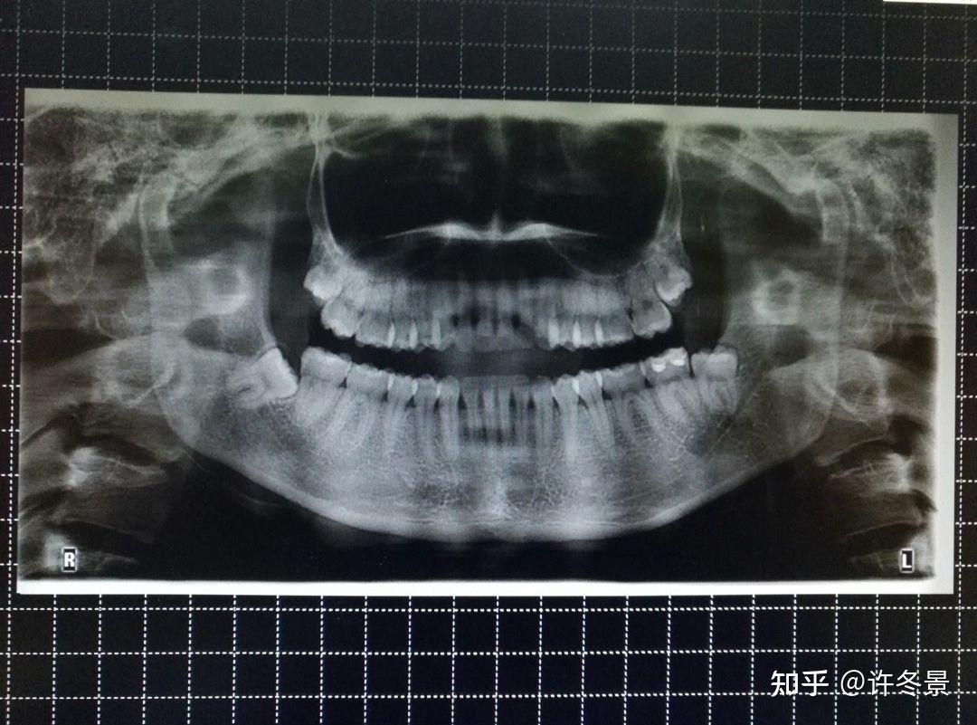 医院拔牙后注意事项~ 知乎