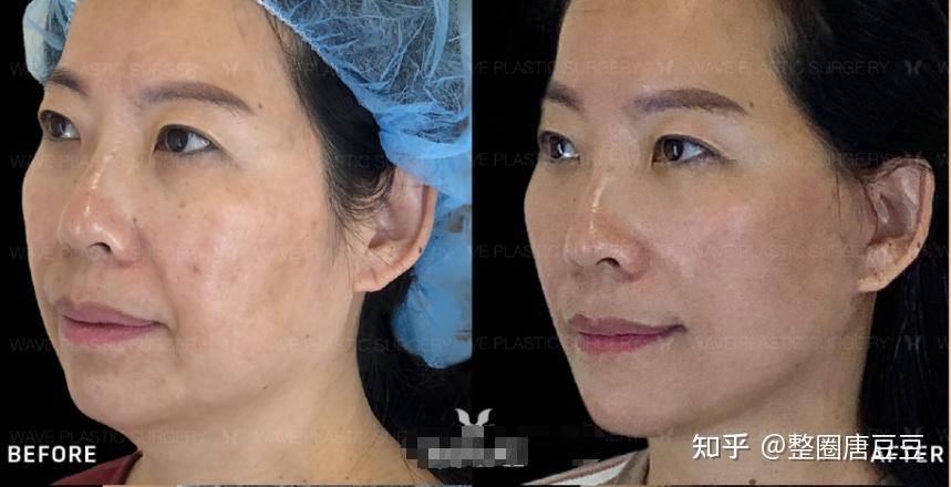 拉皮手术效果真的那么好吗?做一次需要多少钱?能维持多久?(内含避坑攻略)