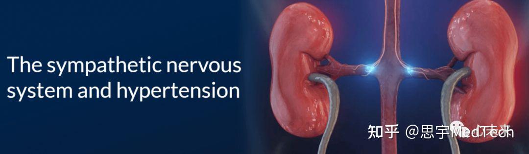 Recor：首创基于超声的RDN获批FDA！ - 知乎