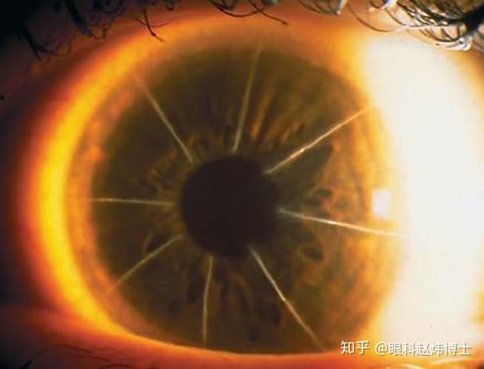 说说RK手术——妖孽，你往哪里跑？ - 知乎