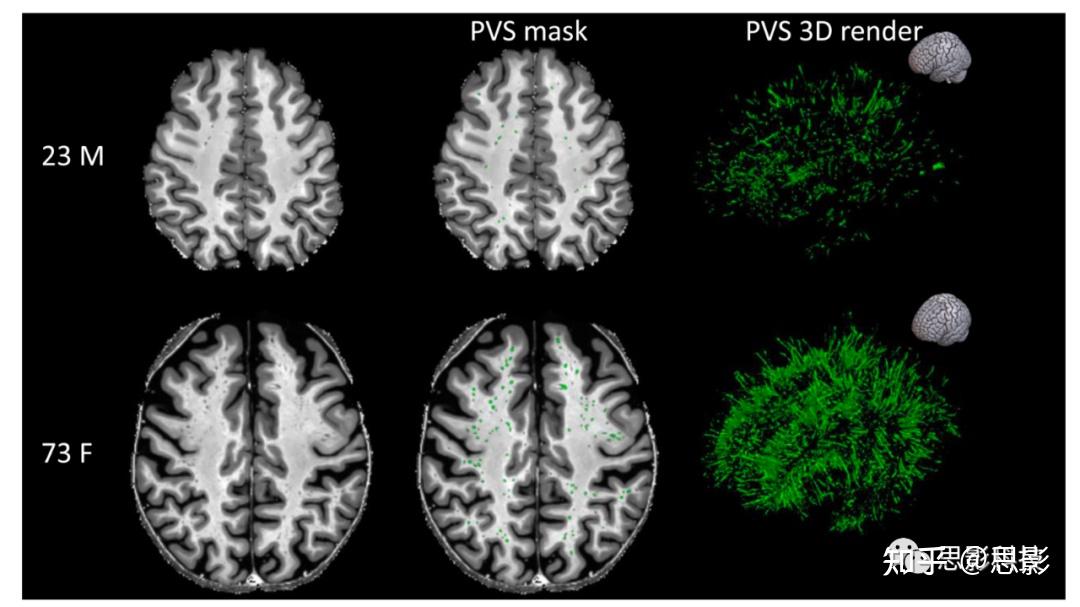 PVS：对血管周围间隙结构和功能的成像 - 知乎