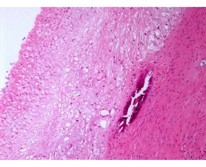 【新品推荐】AAV-PCSK9构建动脉粥样硬化模型 - 知乎