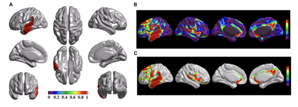 Front.Aging neurosci：中期散发性帕金森病的皮质结构连接改变 - 知乎
