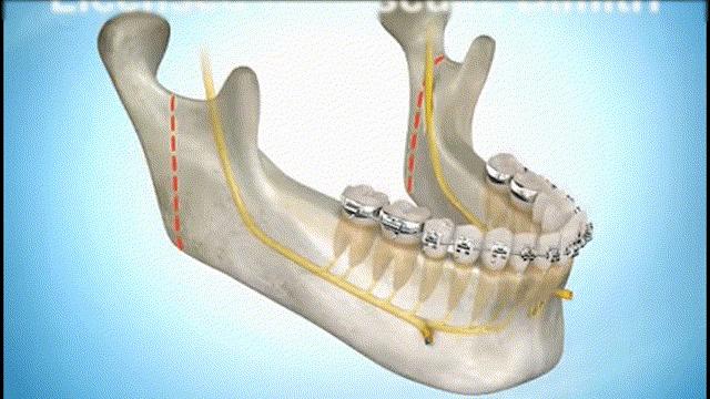 正颌手术都有哪些术式？这组动图让你一目了然！ - 知乎