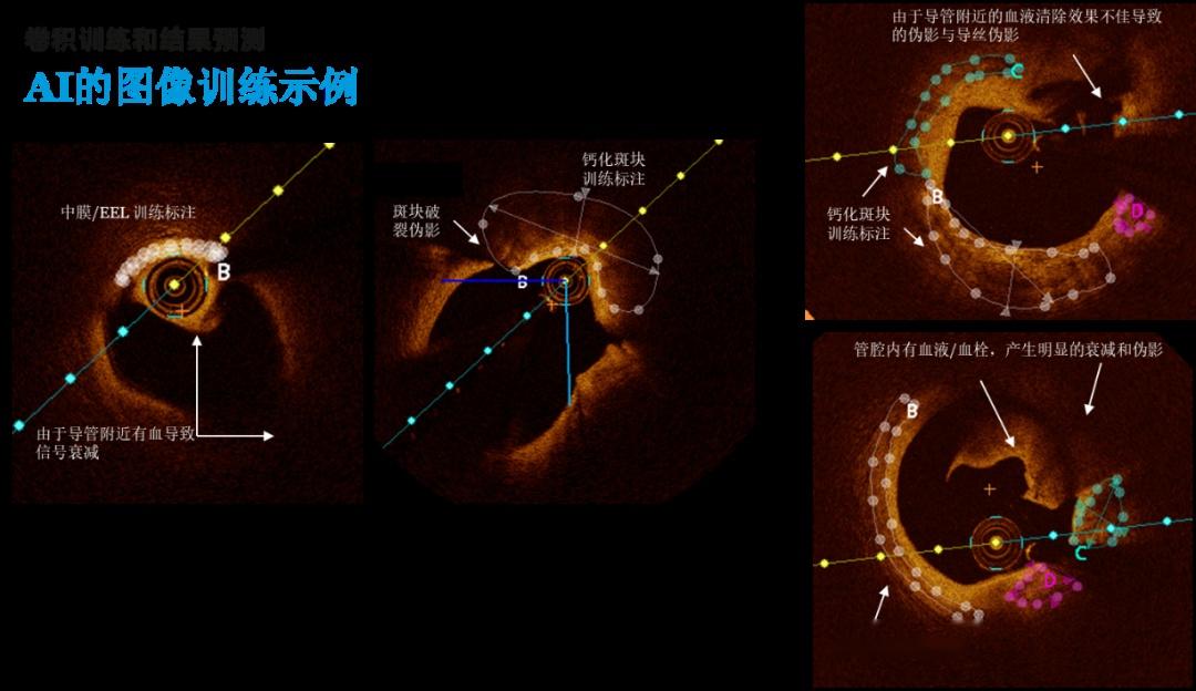 CCEC·前沿技术｜当人工智能“预见”OCT - 知乎