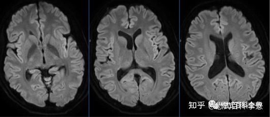 IRIS：多激发SE-EPI扩散（弥散）序列 - 知乎
