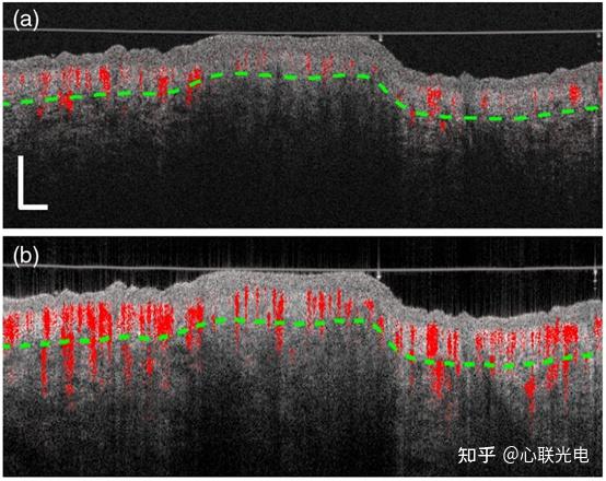 J Biomed Opt：长距离swept-source OCTA在皮肤微循环成像方面的优越性 - 知乎