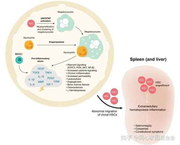 靶向药物时代，重新定义骨髓纤维化治疗目标 - 知乎