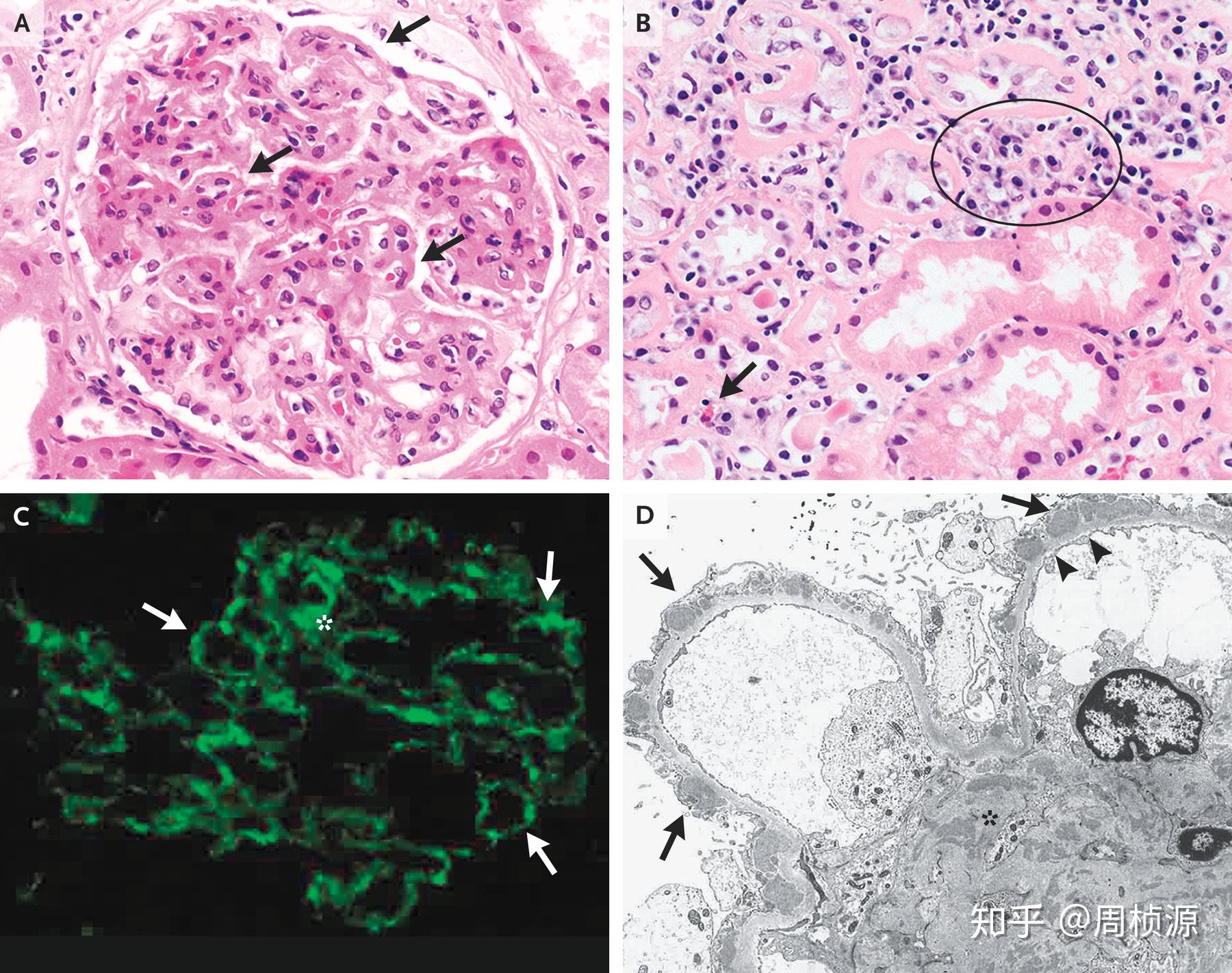 Nejm 2020 Case 34 - 知乎