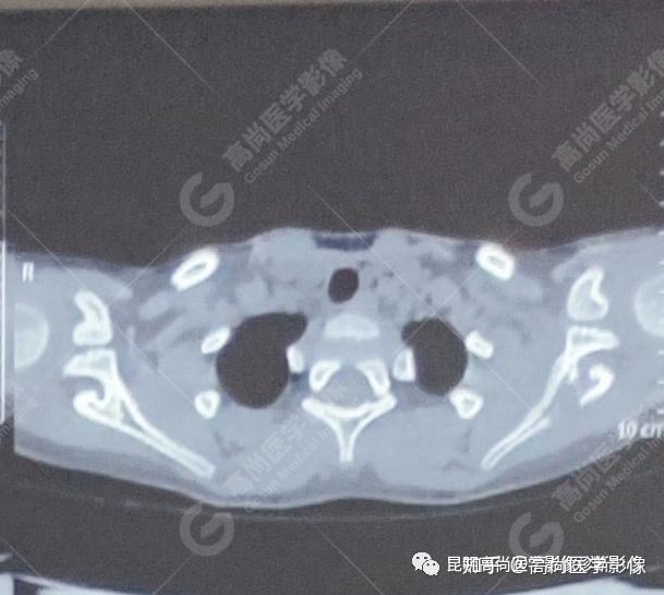 6岁儿童朗格汉斯细胞组织细胞增生症【高尚医学影像】 知乎