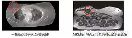 ViewRay MRIdian 磁共振引导放疗 - 知乎