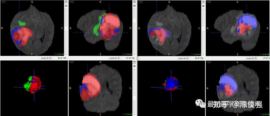 BraTS2023-PED——BraTS2023儿科肿瘤分割挑战赛 - 知乎