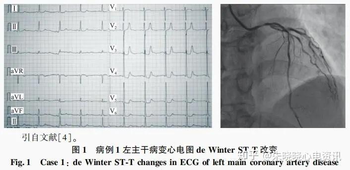 对心电图de Winter ST-T改变的思考 - 知乎